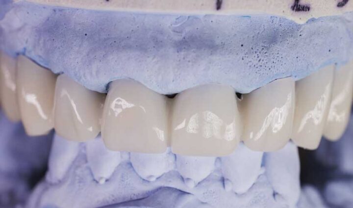 Dental Bridges | Denture Solutions | Smilefocus
