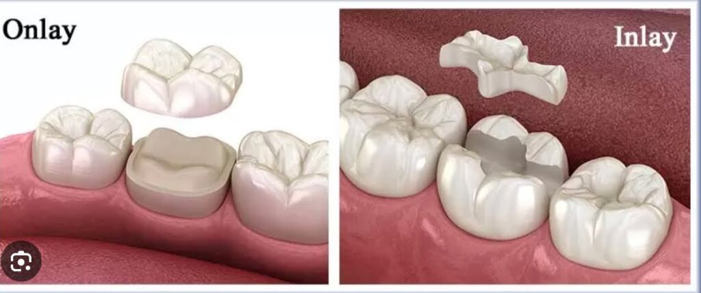 Dental Crown, Inlays & Onlays | Smilefocus